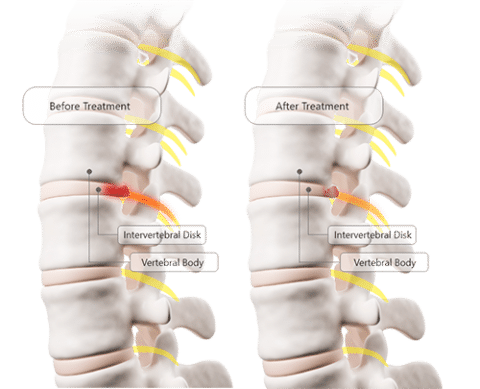 Herniated Disc - Back Center New Jersey